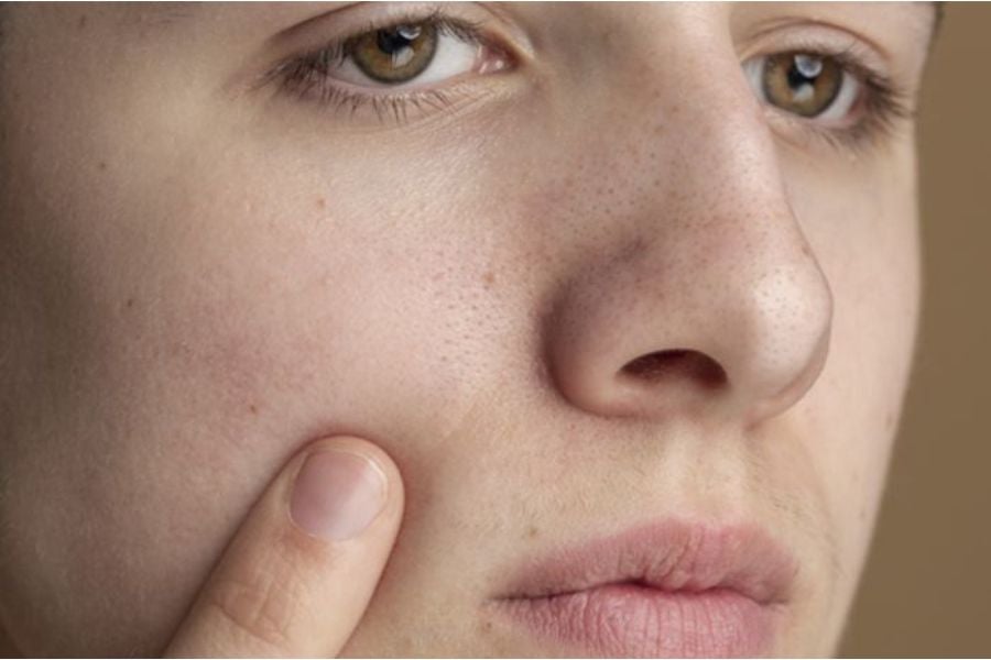 Cravos brancos e pretos: entenda a diferença e como cuidar